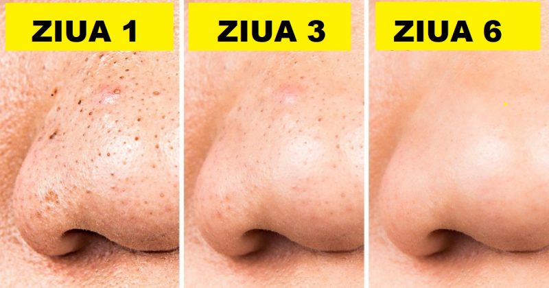 9 remedii NATURALE pentru a scăpa de PUNCTELE NEGRE - Ela Crăciun ...