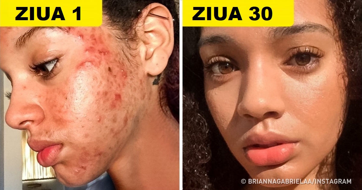 A scăpat de COȘURI cu ajutorul unor produse NATURALE într-o LUNĂ și ...